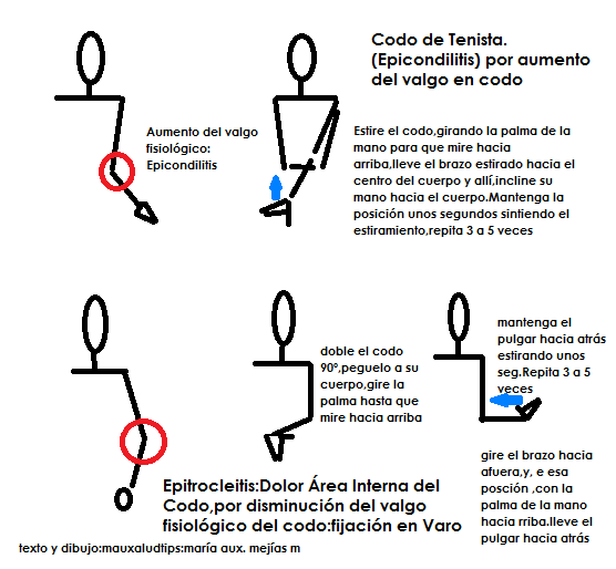 TIPS PARA ALIVIO DIARIO DEL DOLOR: Causas del Codo de Tenista y del ...