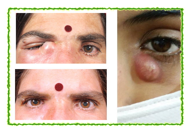 Acute dacrocystitis - Sure Developers Team