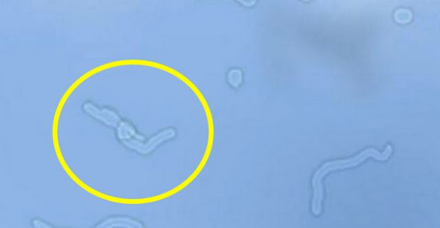 Have you ever noticed those worm-like floaters in your eyes?