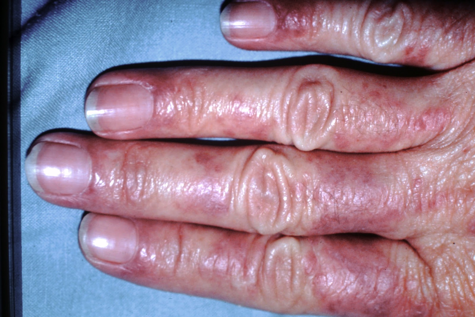 Systemic Lupus Erythematosus Lupus Rash On Palms Of H - vrogue.co