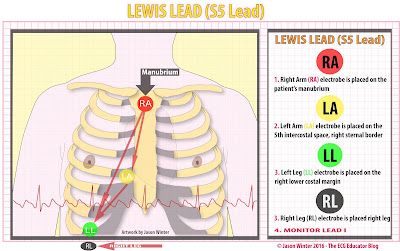 ECG Educator Blog : Atrial Flutter