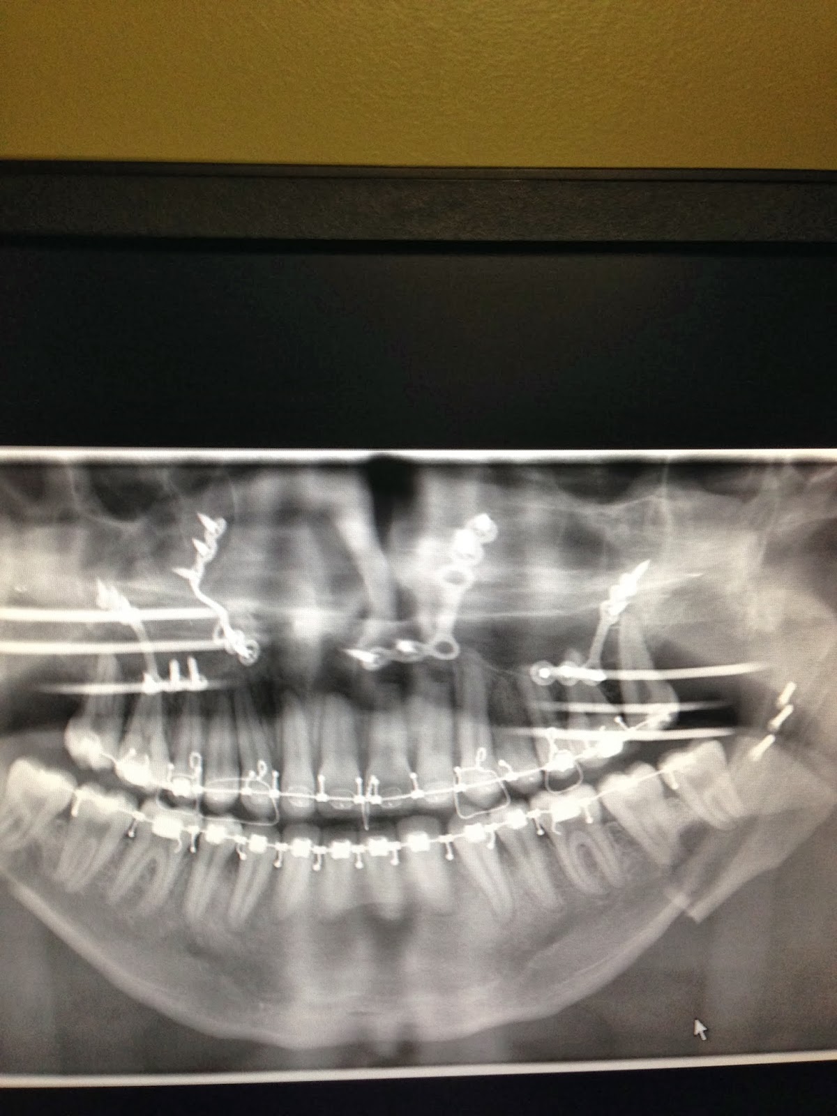 Double Jaw Surgery (Lefort I Advancement Bilateral BSSO (Bilateral ...