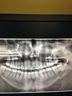 Double Jaw Surgery (Lefort I Advancement Bilateral BSSO (Bilateral ...