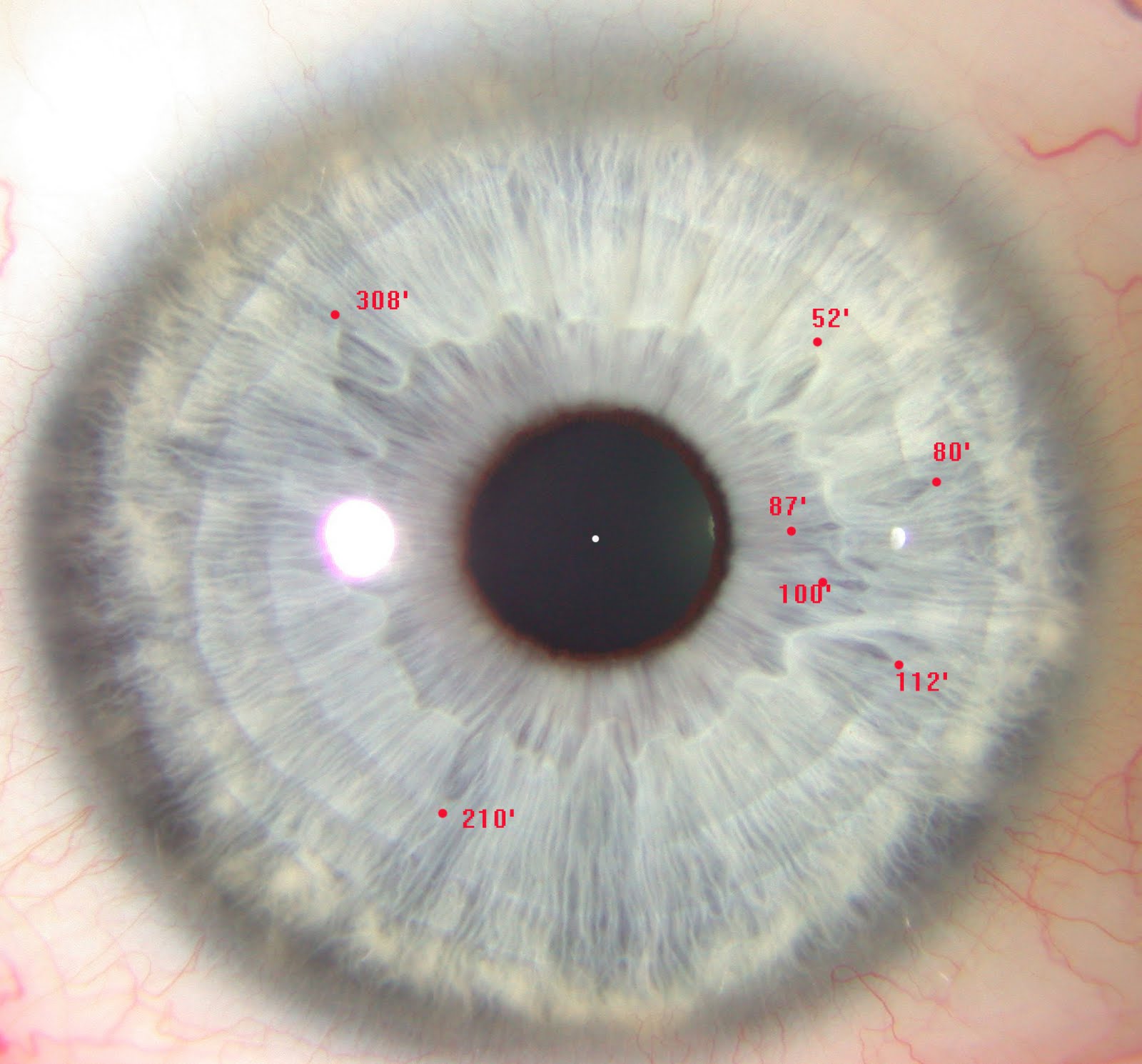 Ring Of Purpose Iridology at Edward Acosta blog