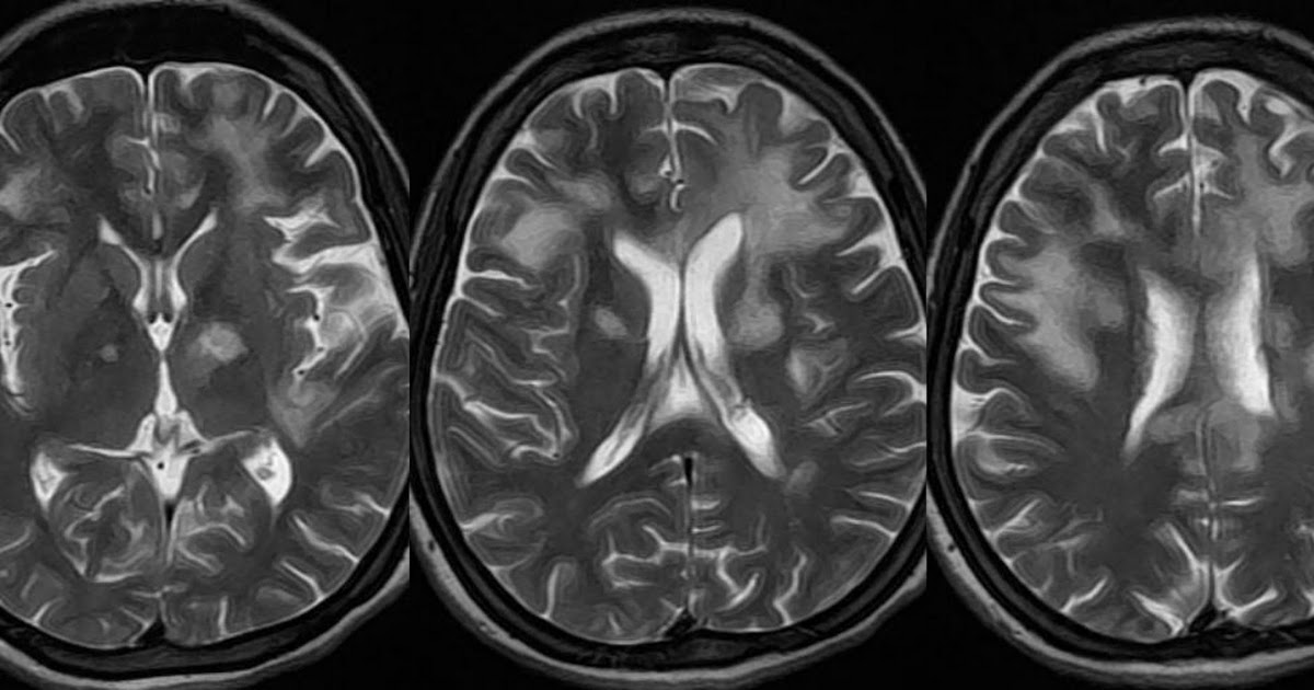 Neuroradiology Cases: Progressive Multifocal Leukoencephalopathy (PML)