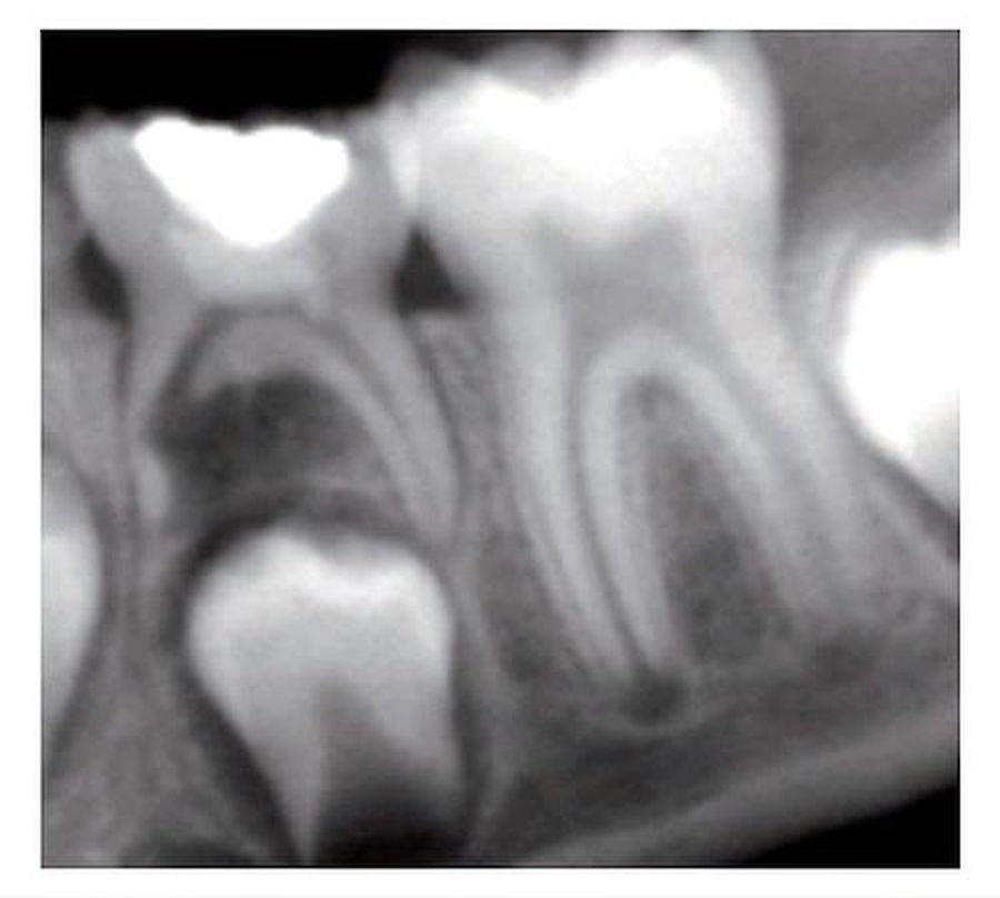 PDF: Reabsorciones radiculares: tipos, causas y manejo - Ovi Dental
