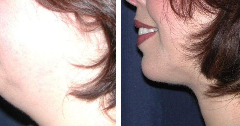 Natural Neck Lift - Pukrol Satwa