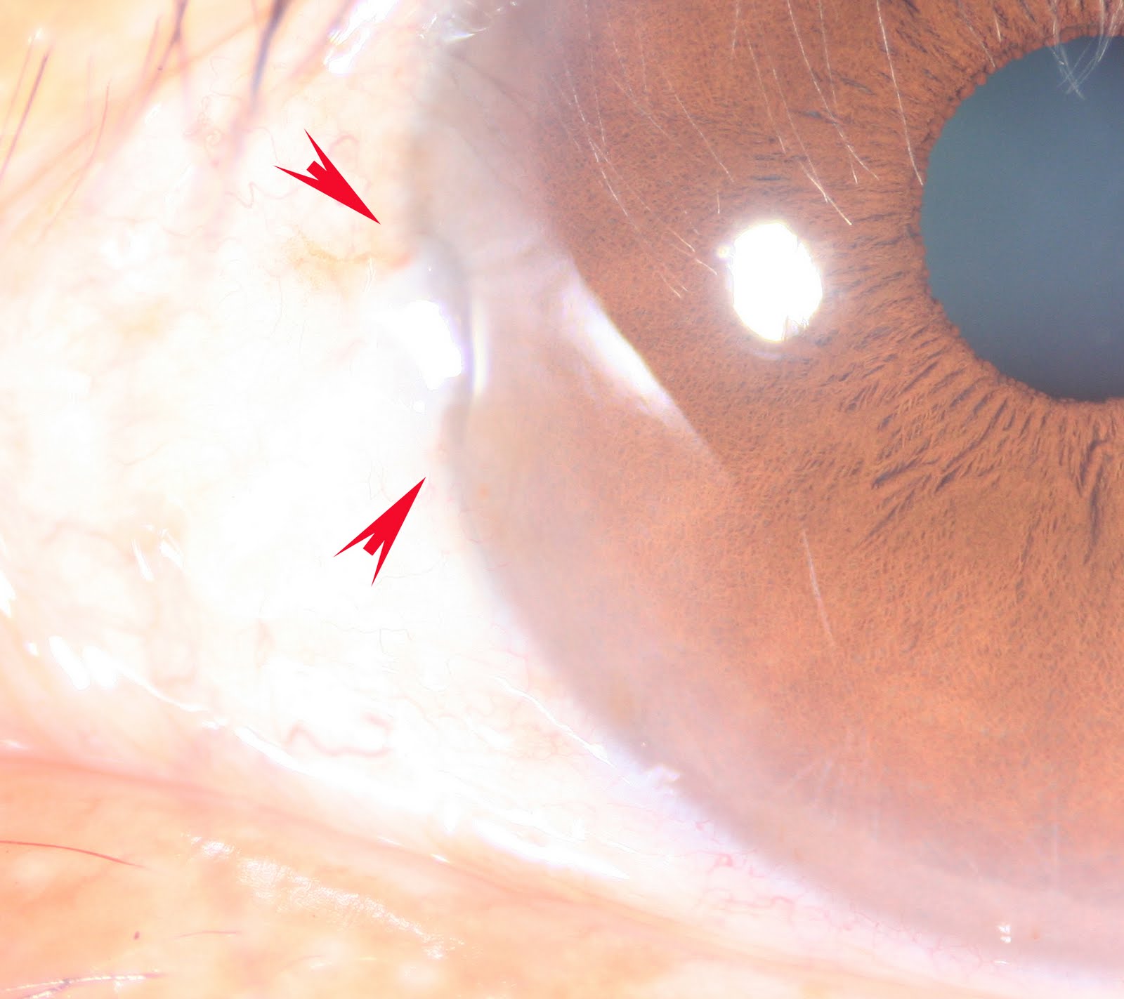 Modern & Multidimensional Iridology: Initial Formation of Pterygium - (sla)