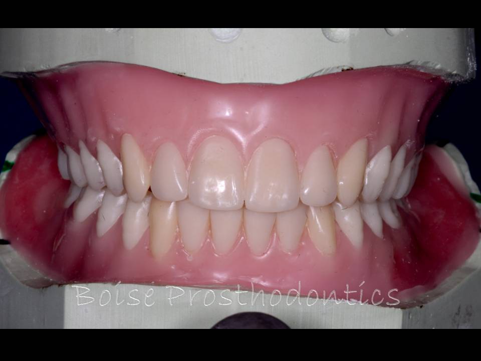 Boise Idaho Prosthodontics: Picture Sequence of Maxillary Complete ...