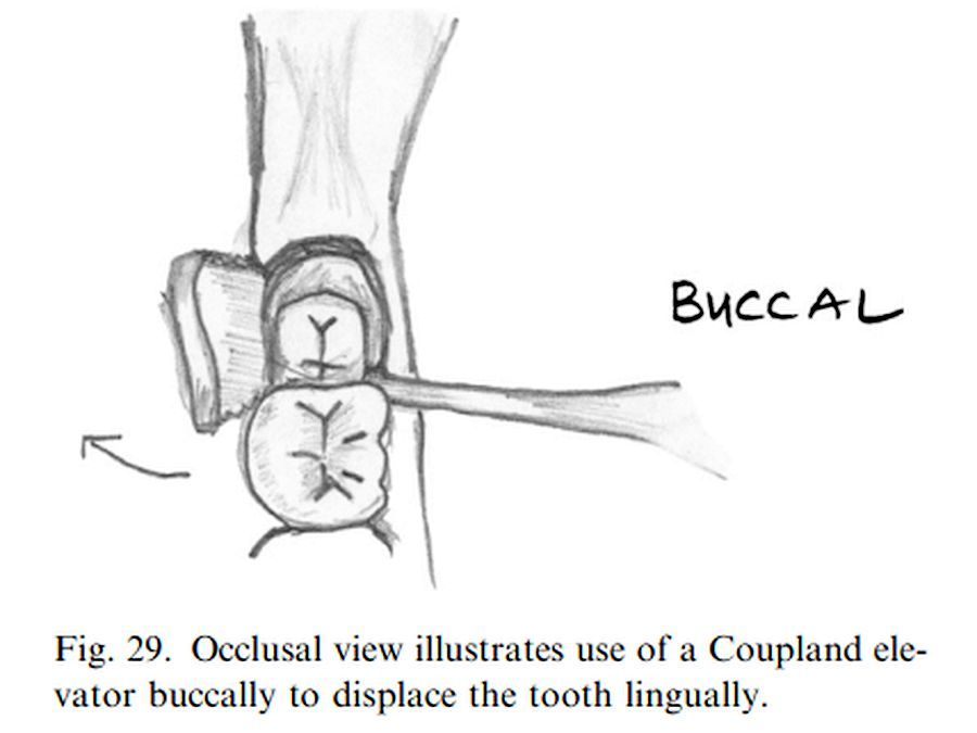 PDF: General technique of third molar removal - Ovi Dental