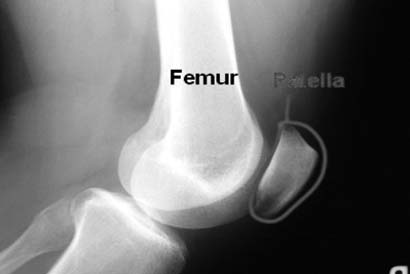 Radiology..."it's So Fun": Teknik Radiografi Os Patella