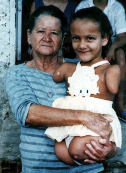 Focomelia: Importante pero desconocida