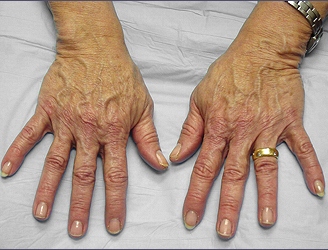 Plastic and Cosmetic Surgery: Fat Injection – A boon for the Plastic ...