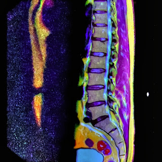 Nevit's blog: Color MRI of the Lumbar vertebrae