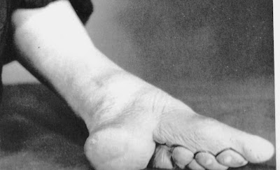 Pieces of Brocade...: Footbinding – an iniquitous Chinese custom