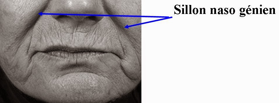 LE SILLON NASOGÉNIEN, LA LIMITE HAUTE DU SOURIRE