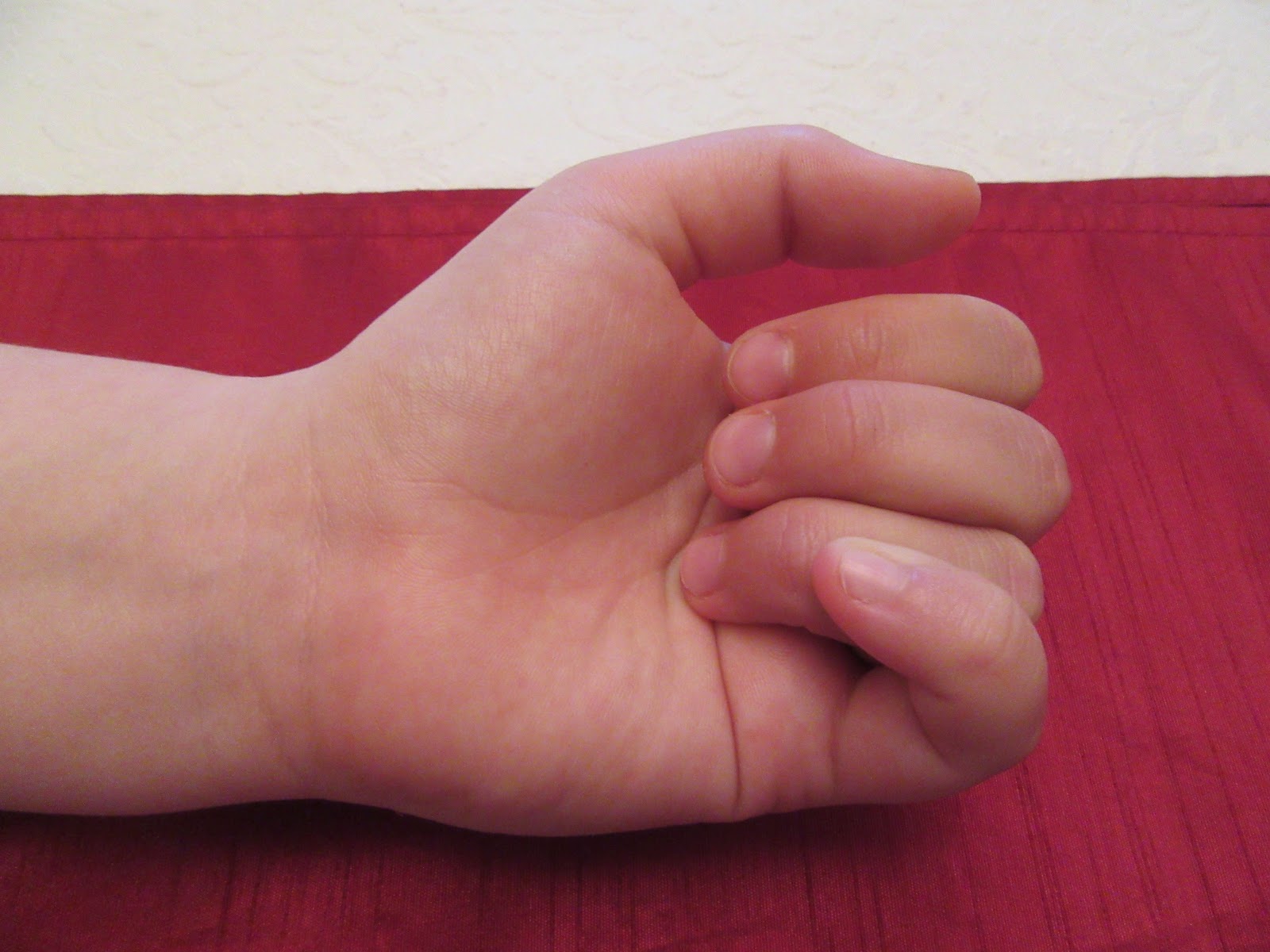 Paediatrics for Primary Care (and anyone else): Minor injuries - three ...