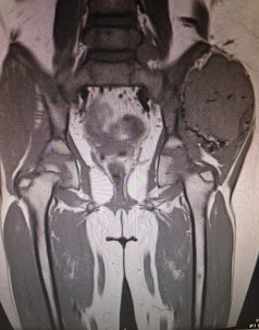 VIETNAMESE MEDIC ULTRASOUND: CASE 428: BUTTOCK TUMOR ASPS, Dr PHAN ...