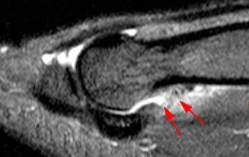 MRI Musculo-Skeletal Section: Turf toe.