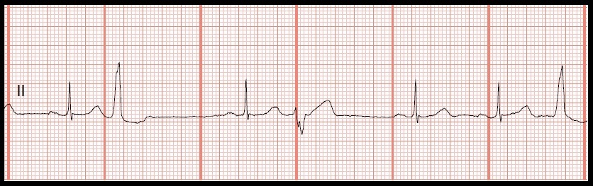Practice EKG Rhythm Strips 191