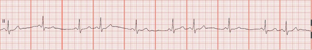 ECG Rhythm Strip Quiz 67