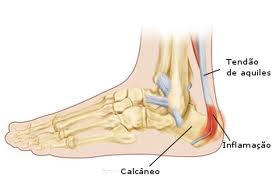 BUSQUE! : DOR NO CALCÂNEO.