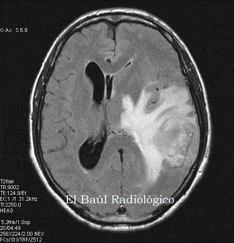 El Baúl Radiológico: 1) EDEMA VASOGÉNICO EN EL SISTEMA NERVIOSO CENTRAL ...