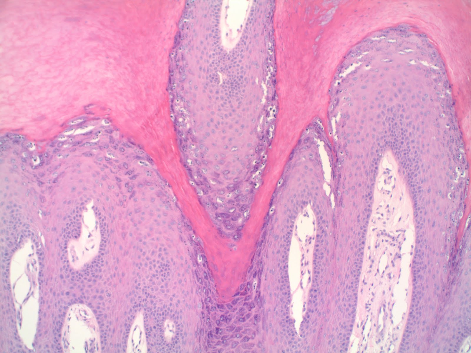 Dermatopathology: Verruca vulgaris