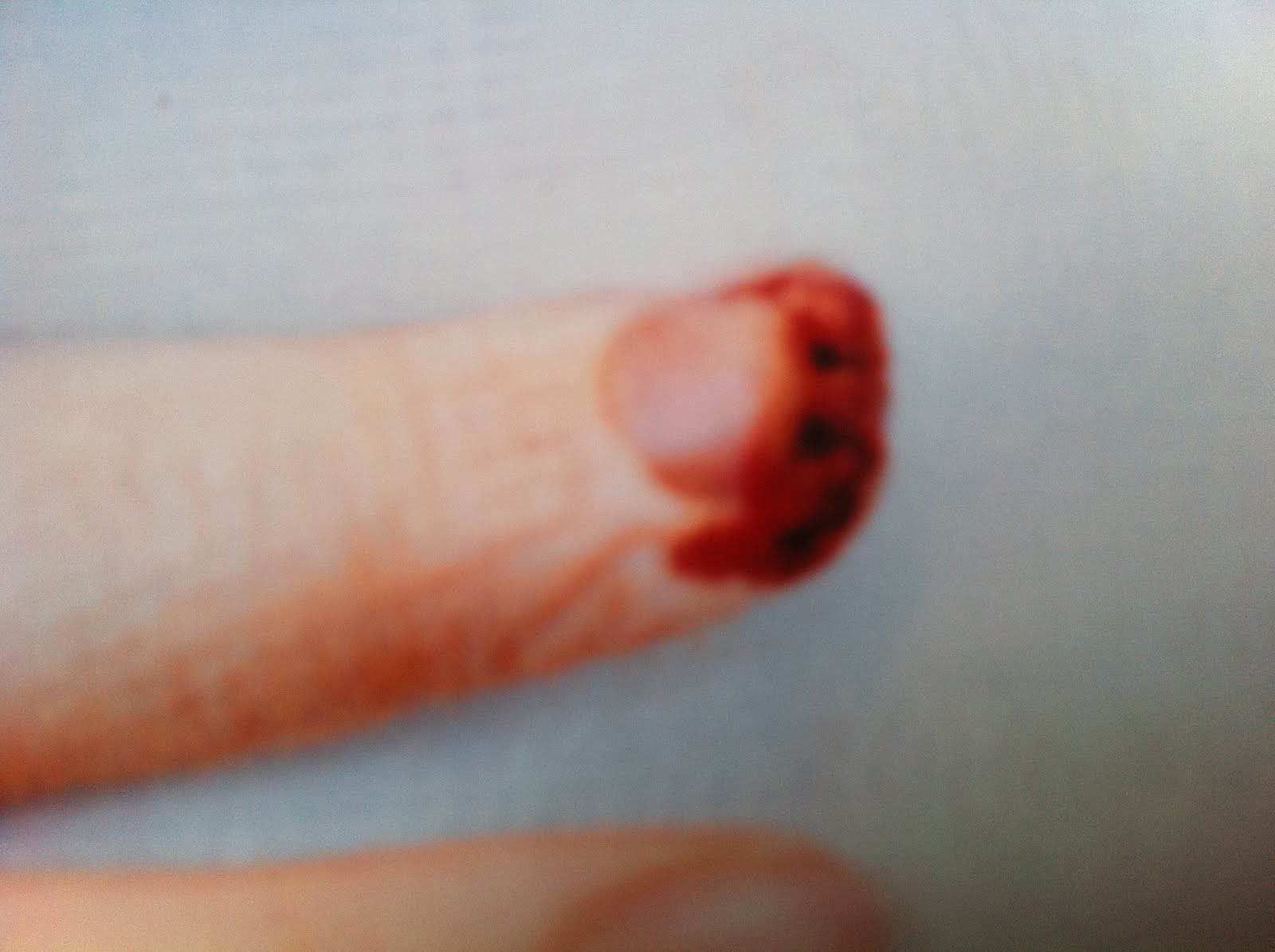 My Photo Book: My Partially Amputated Finger