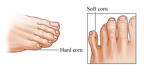 InStride Family Foot Care: Corns