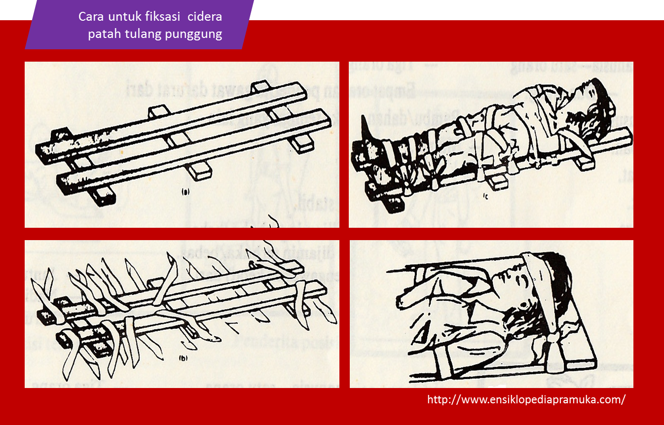 PPPK : Jenis dan Cara Pembidaian (Splenting)