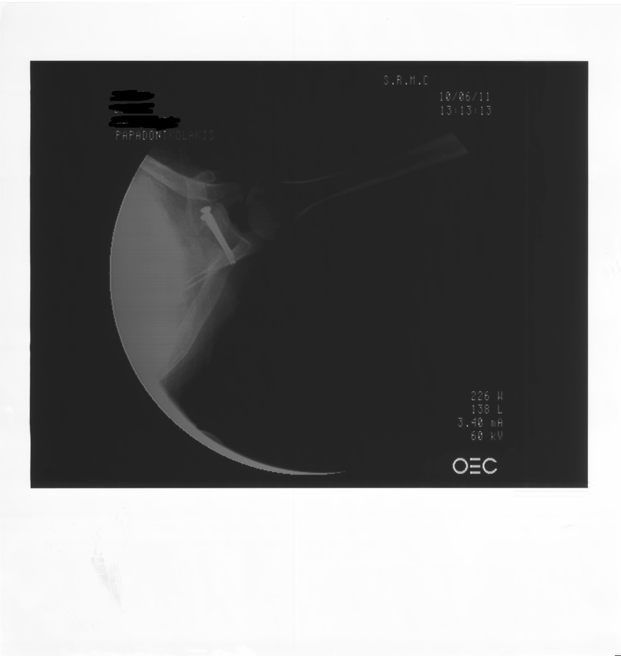 Shoulder and Elbow Surgery: The patient with the 30 shoulder ...