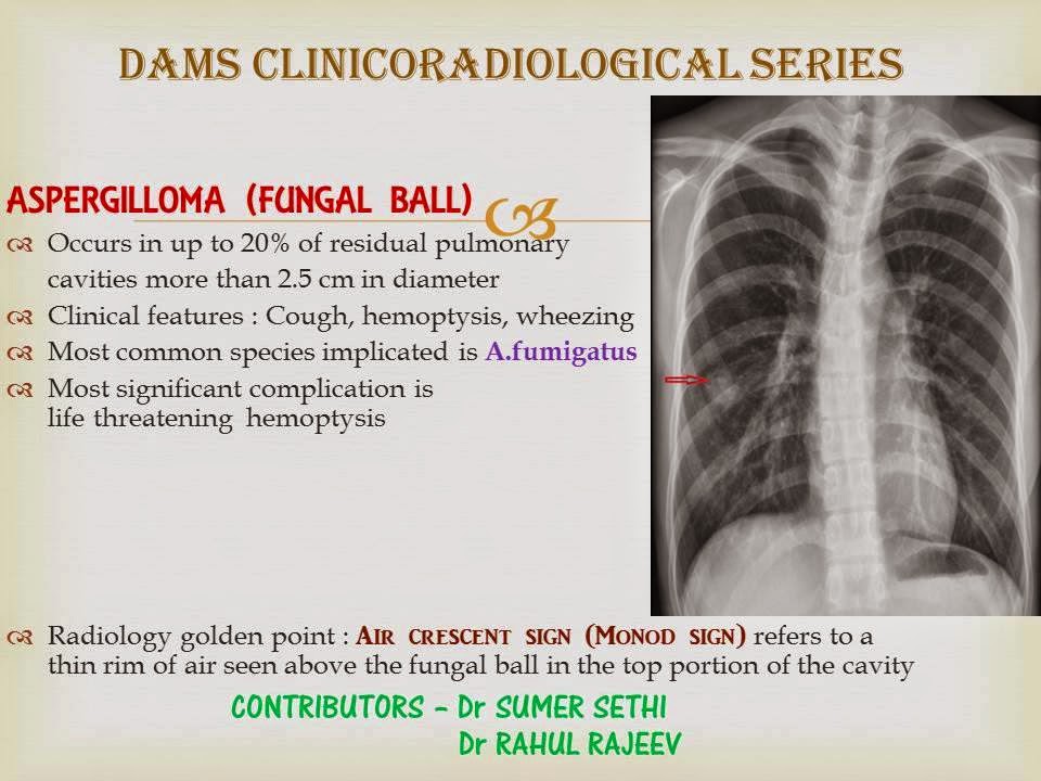 Aspergilloma: Clinicoradiological Series - Radiology Imaging