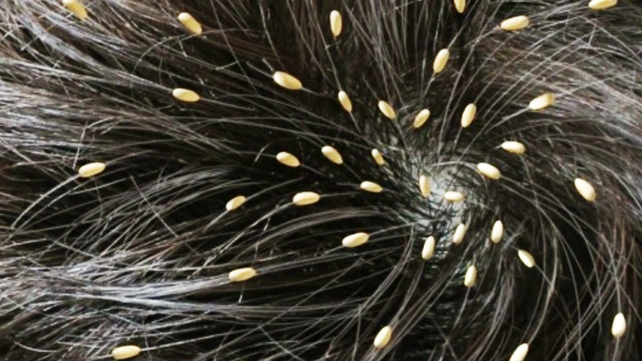 Head lice infestation