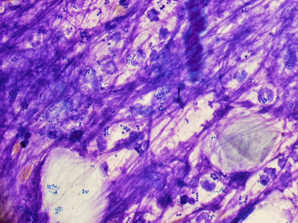 Dermatološka sekcija Slovenije: Methicillin-resistant Staphylococcus ...