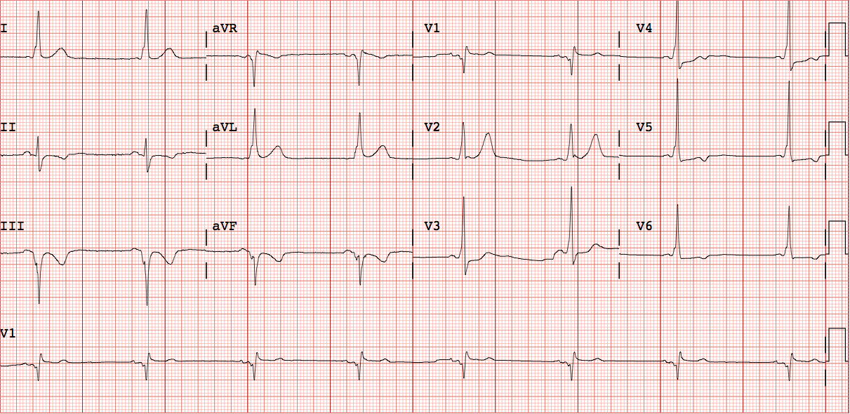 Dr. Smith's ECG Blog: WPW mimicking and obscuring acute MI