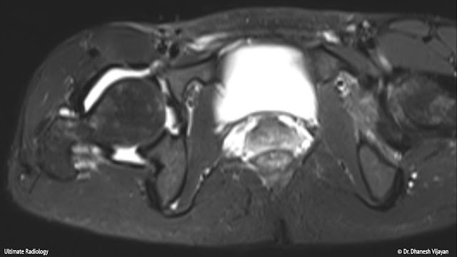 Ultimate Radiology : Septic arthritis of hip joint