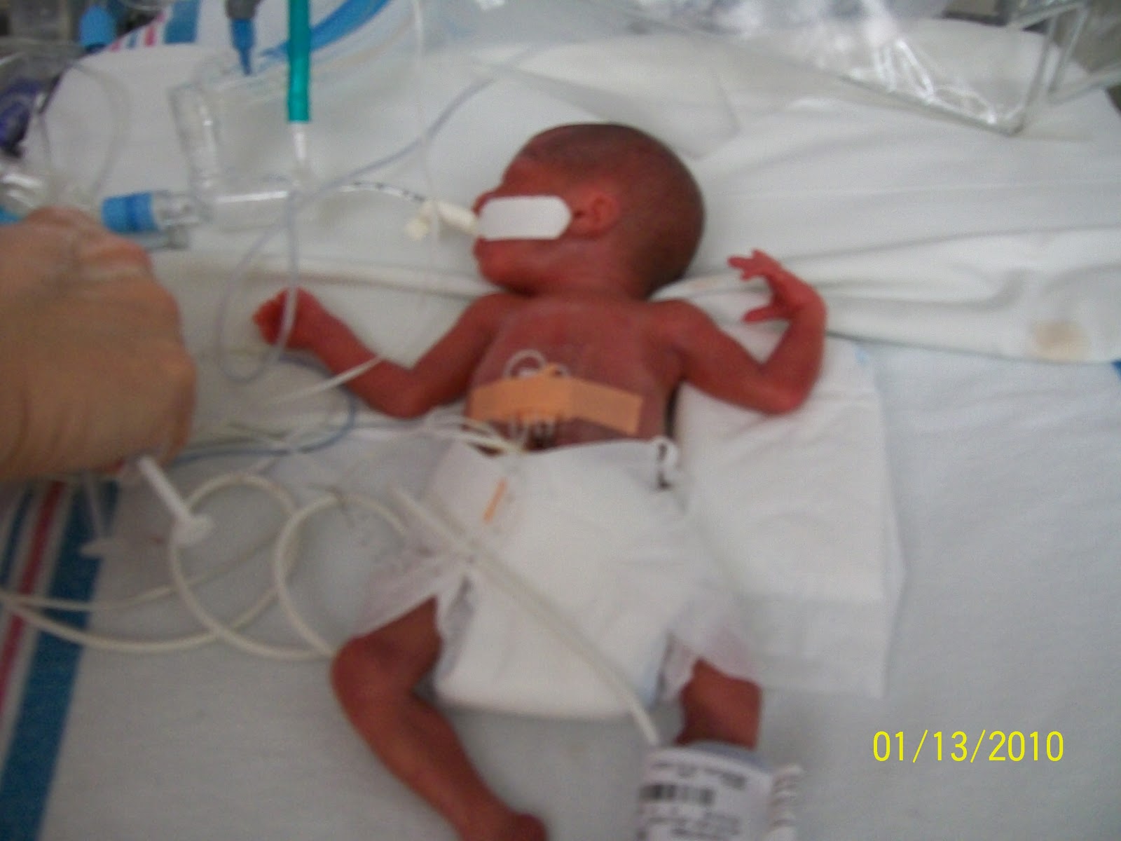 24 Weekers and Other Preemie Babies: pictures. day 1.....1 pound 4 oz each