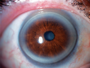 ¡Un Optómetra previene la ceguera, no vende gafas!: Arco Senil o Geróntoxon