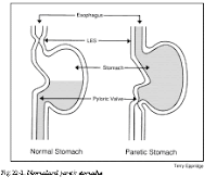 Gastroparesis: A Complications of Diabetes