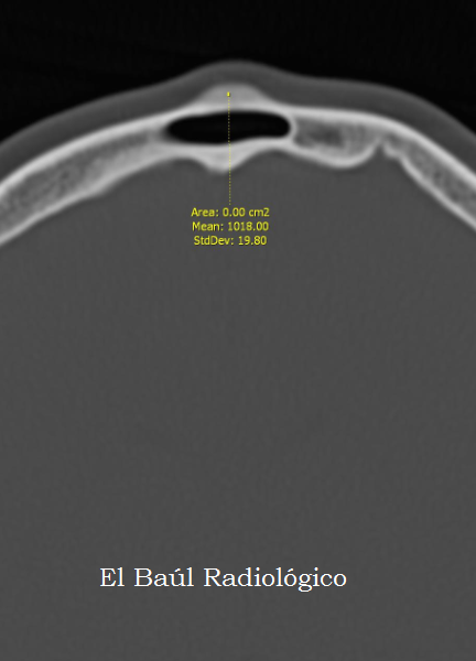 El Baúl Radiológico: OSTEOMAS CRANEALES. (Cranial Osteomas. CT Findings ...