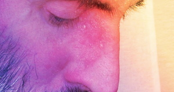 Psoriasis en la Cara | Tratar la Psoriasis en la Cara | Productos ...