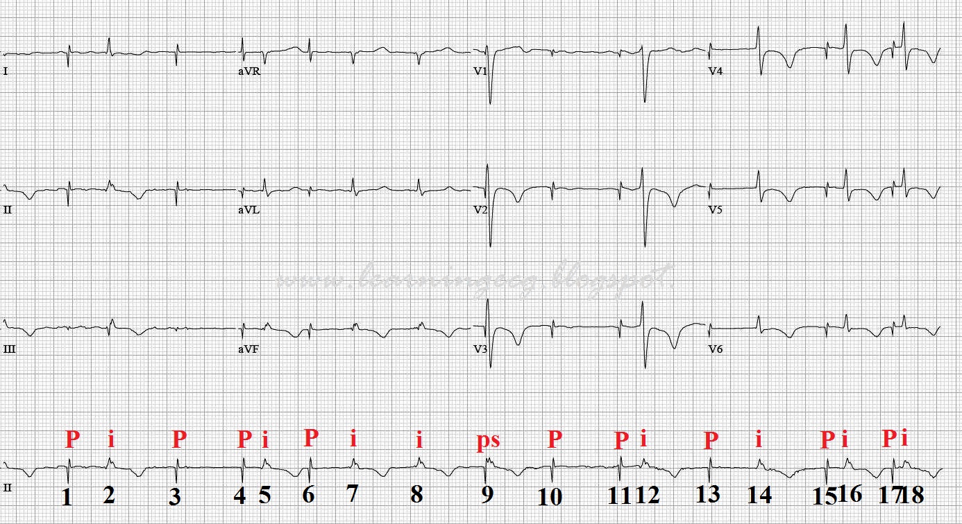 ECG Rhythms: AF with failure to capture and intermittent undersening
