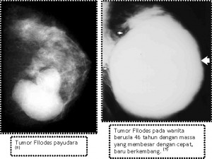 Dr Herry Setya Yudha Utama SpB. FInaCS. MHKes. ICS: Tumor Phylloid ...