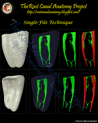 The Root Canal Anatomy Project: Single-File Technique Sample 4