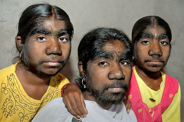 3 Indian Sisters Suffering from Rare WereWolf Syndrome (Photos) - The ...