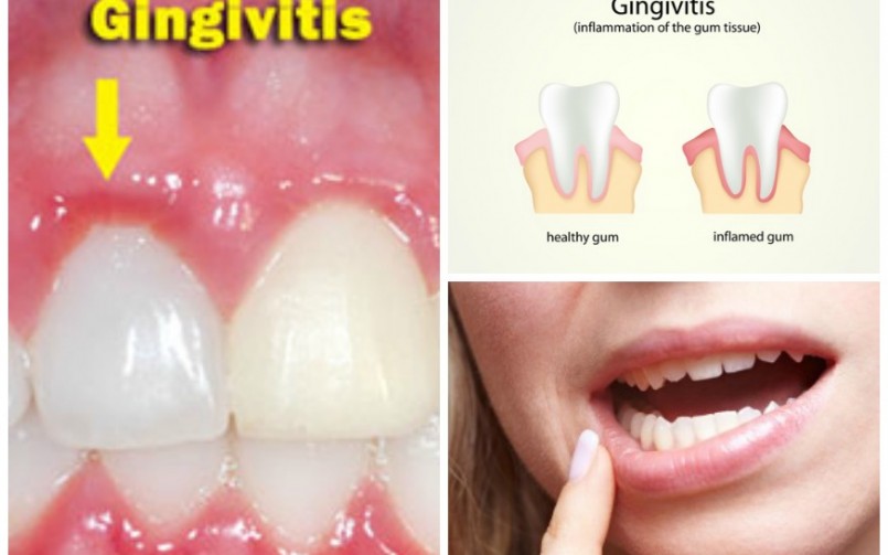Pharmacy Outlet: Common Facts About Gingivitis