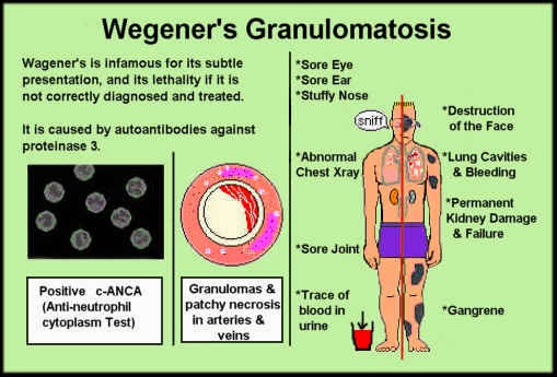 Wegener Granulomatosis; Granulomatosis, Wegener's