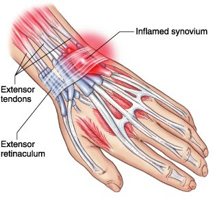 MECANISMOS TENDINOSOS FLEXORES (extensor tendinous mechanisms)