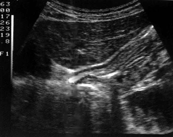 imagini ecografie esofag | Terapii naturiste si Tratamente